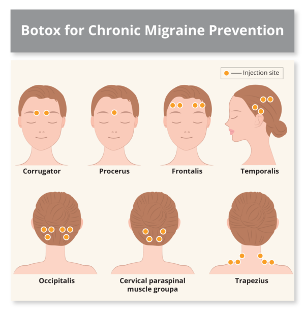 Botox for Migraine - Migraine World Summit