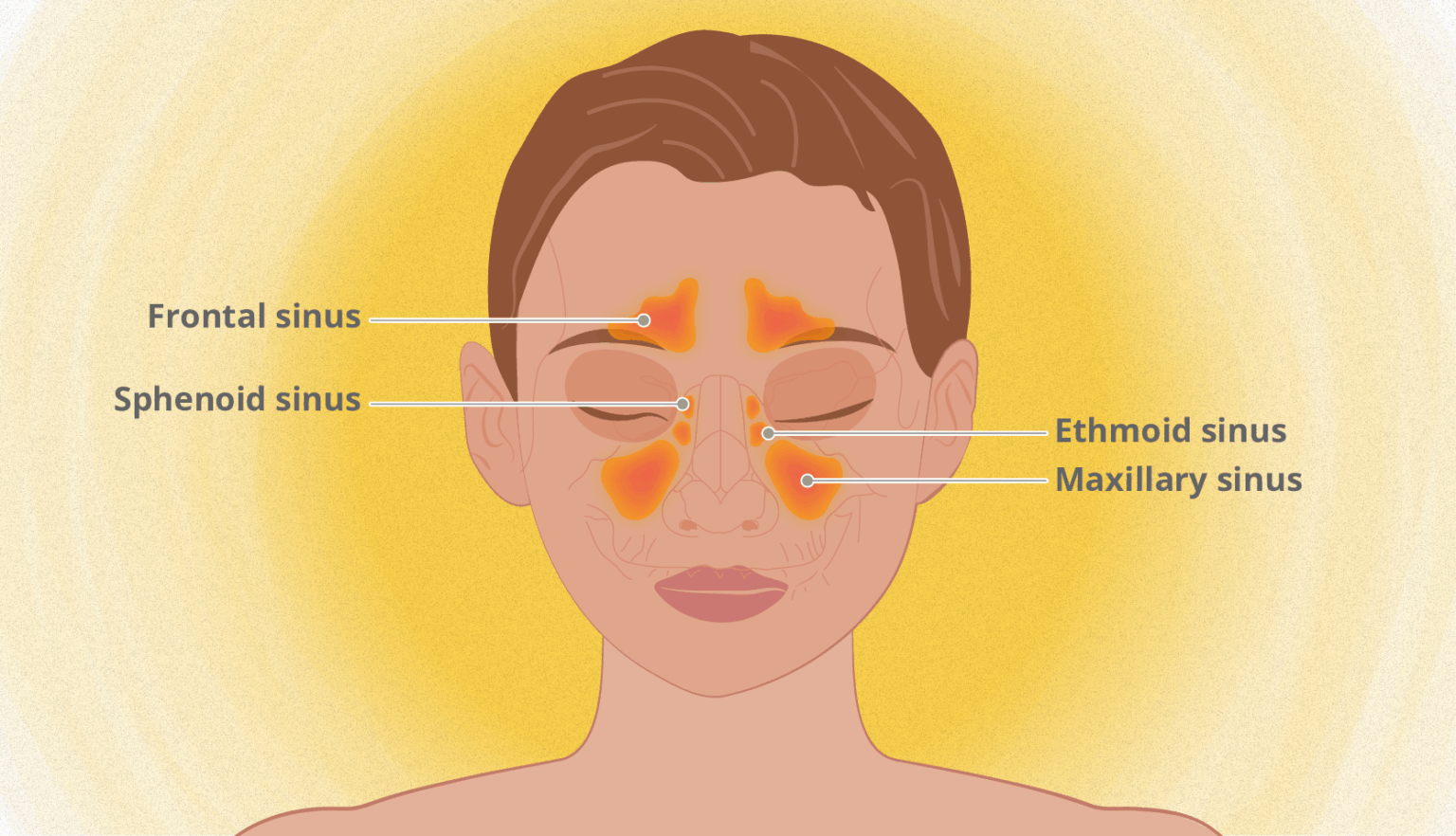 Sinus Headache: Causes, Symptoms, and Relief - Migraine World Summit